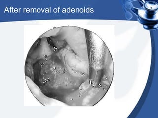 Adenoidectomy | PPTX