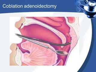 Adenoidectomy | PPTX
