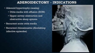 Adenoidectomy and tonsillectomy | PPTX