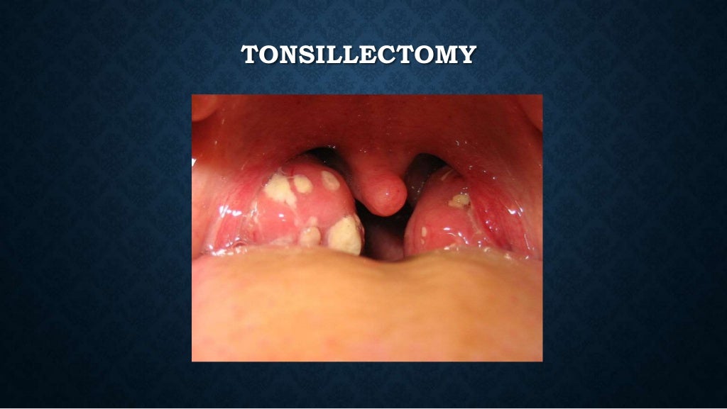 Adenoidectomy and tonsillectomy
