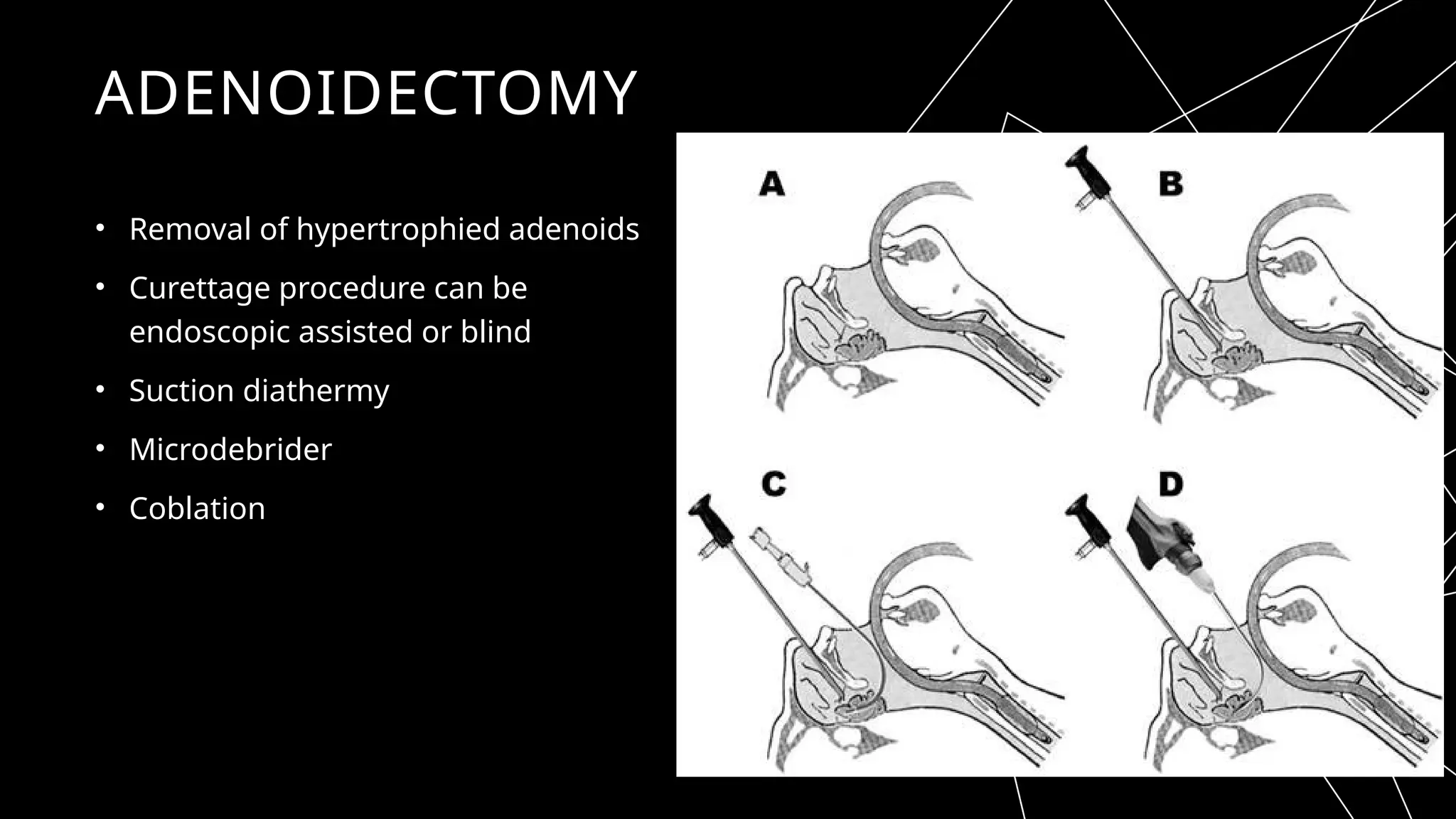 Adenoidectomy, septoplasty and inferior turbinate reduction | PPTX
