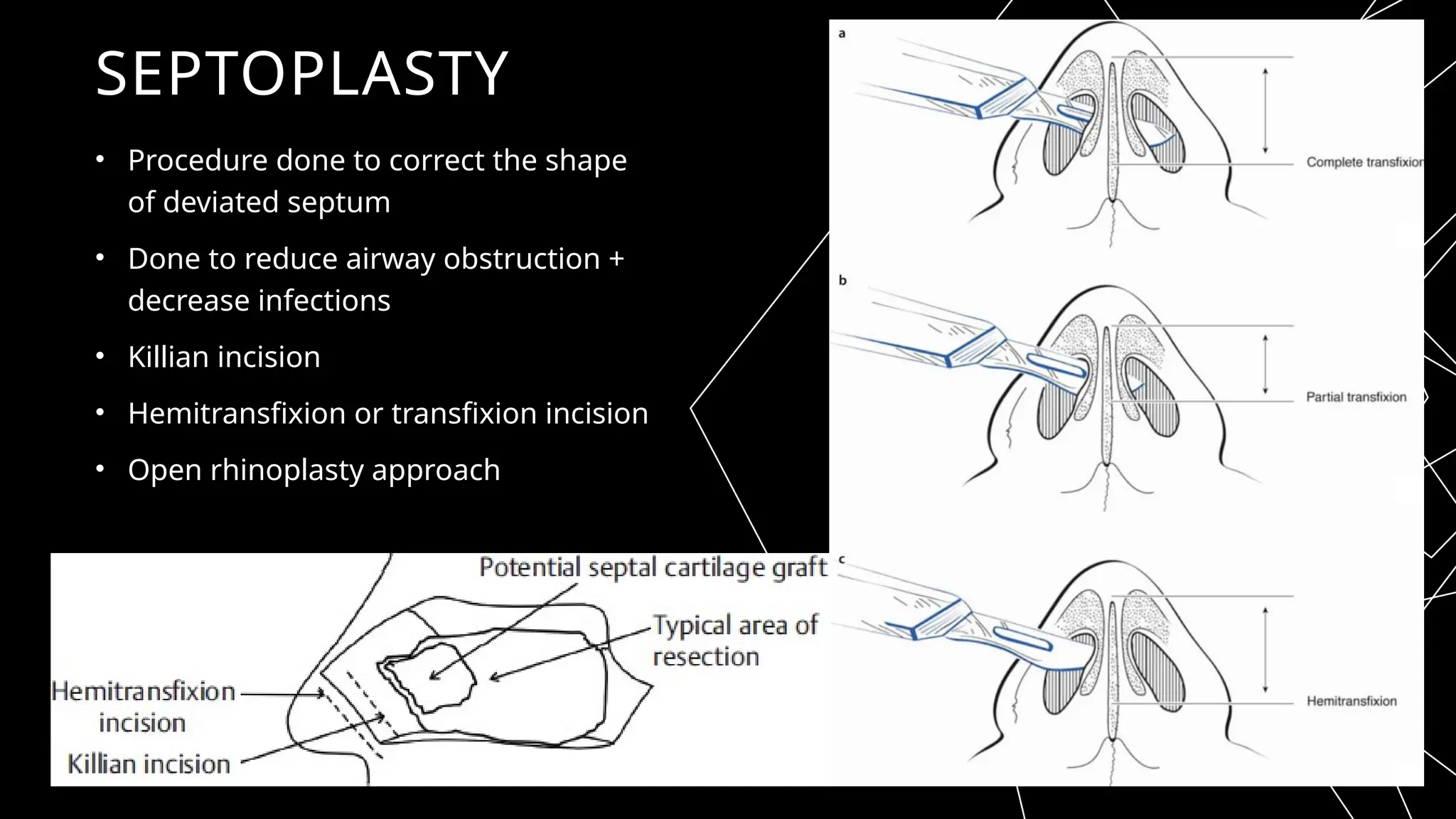 Adenoidectomy, septoplasty and inferior turbinate reduction | PPTX
