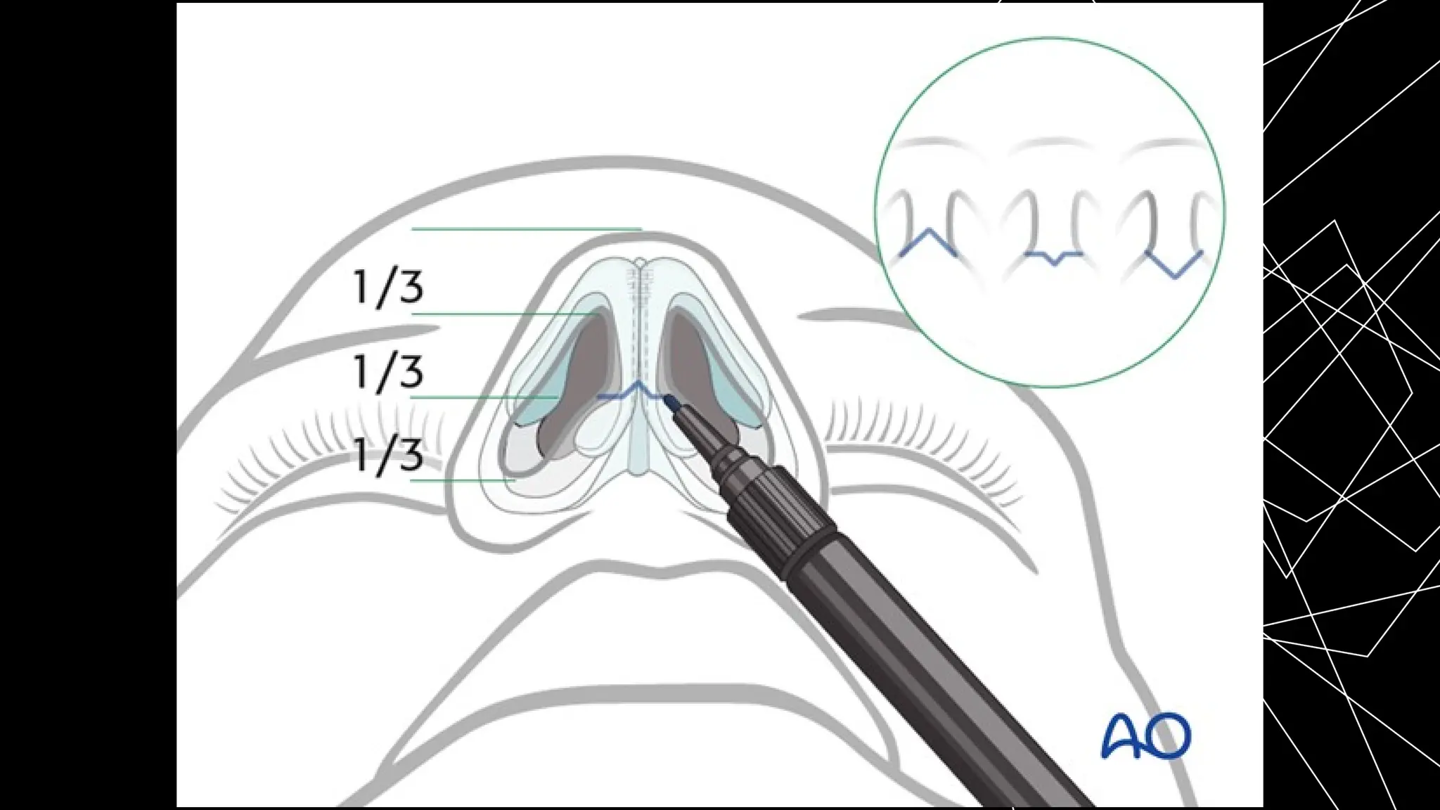 Adenoidectomy, septoplasty and inferior turbinate reduction | PPTX