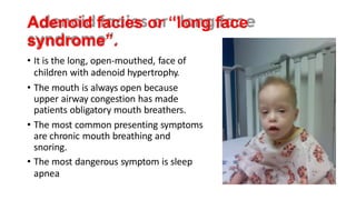 Adenoid Enlargement.pptx