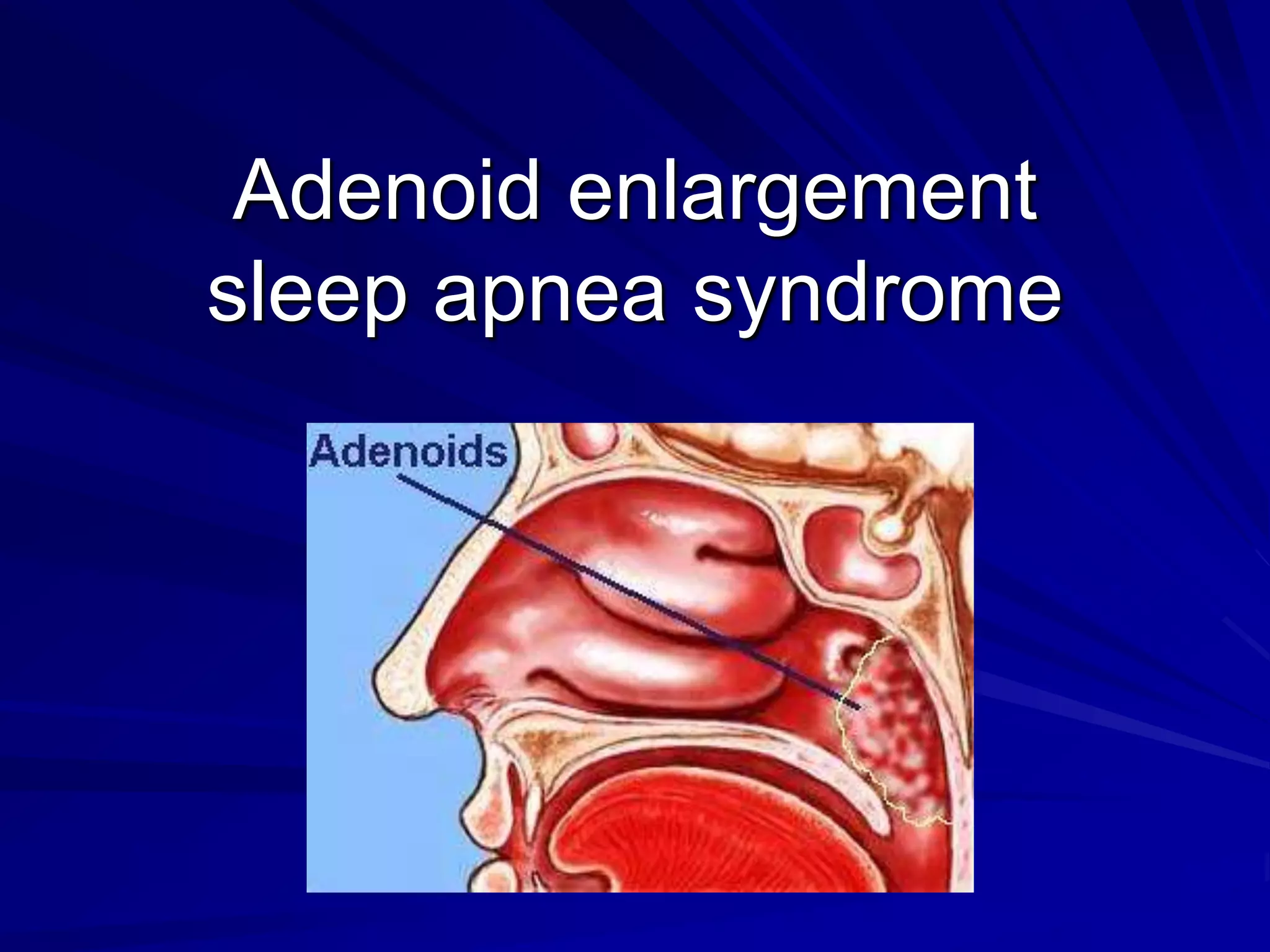 Adenoid enlargement.ppt
