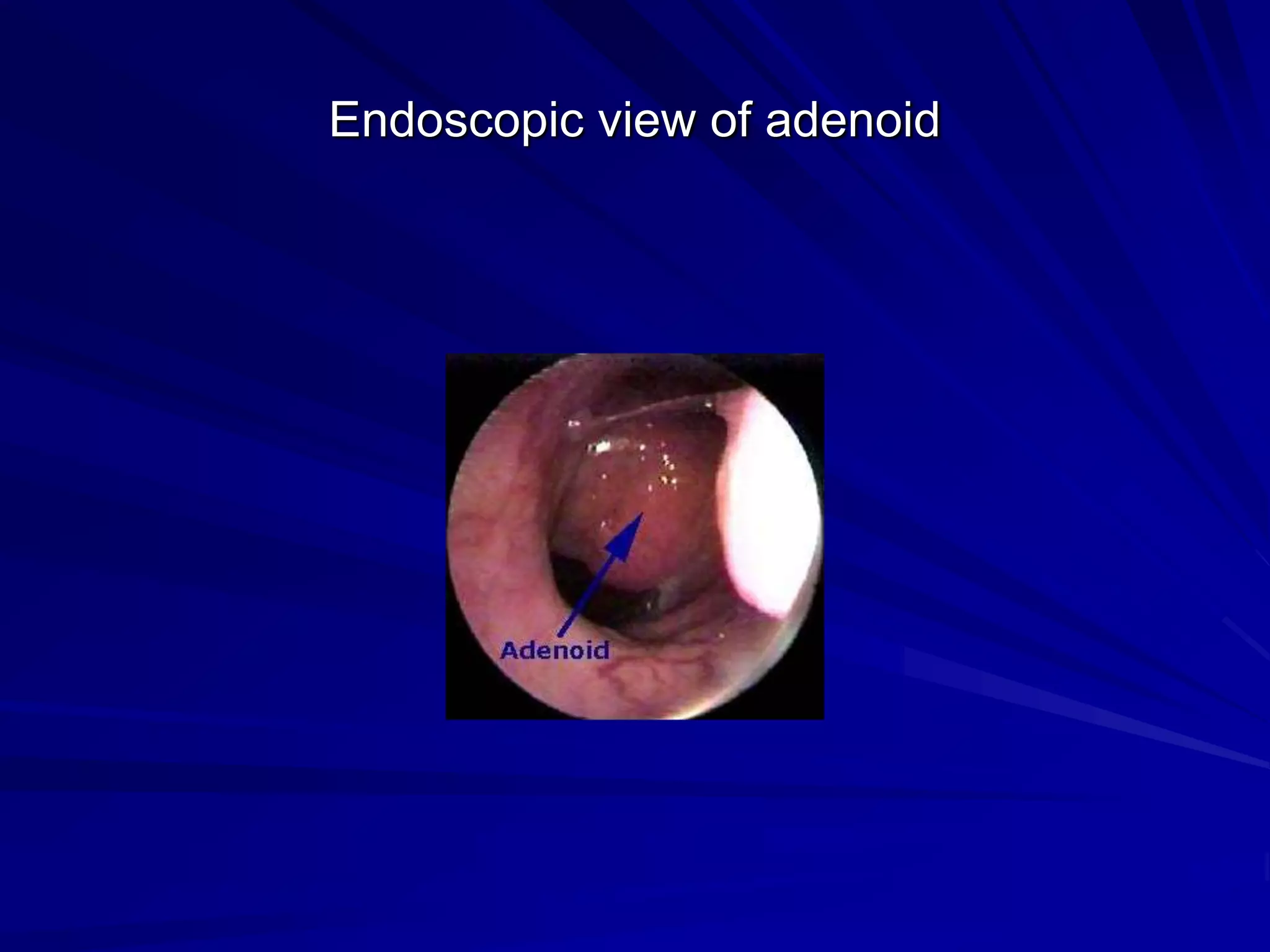 Adenoid enlargement.ppt