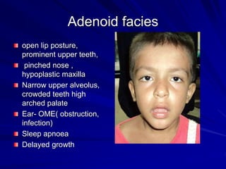 Adenoid enlargement.ppt