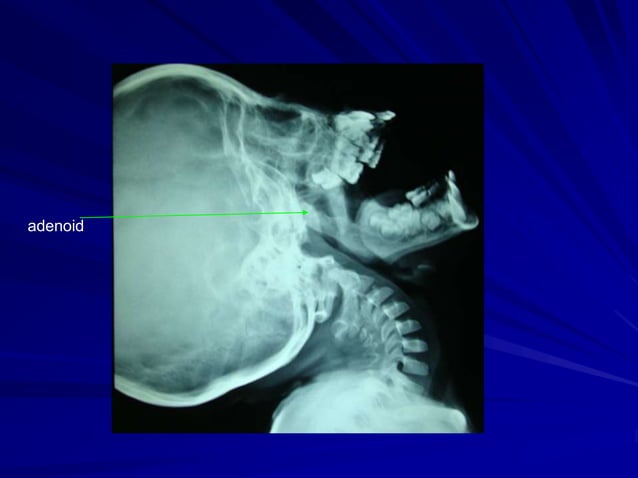 Adenoid enlargement.ppt