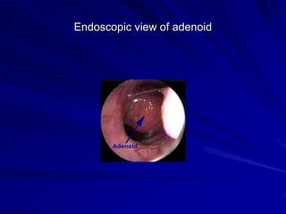 Adenoid enlargement.ppt