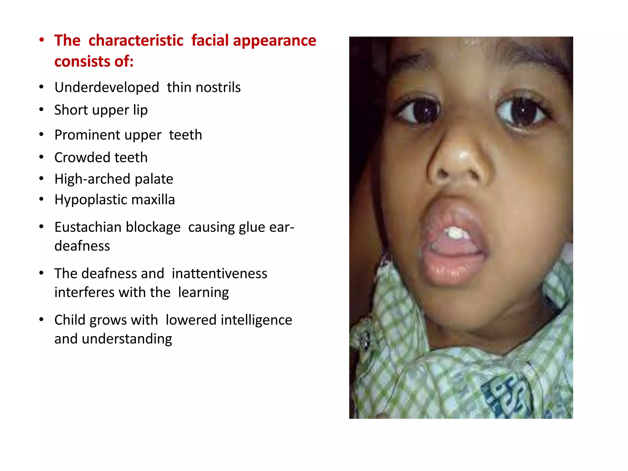 Adenoid Enlargement in children.pptx