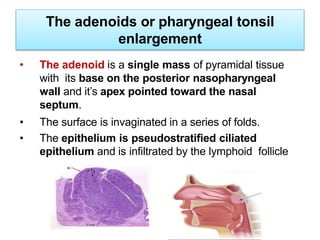 Adenoid Enlargement in children.pptx