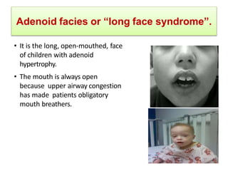 Adenoid Enlargement in children.pptx
