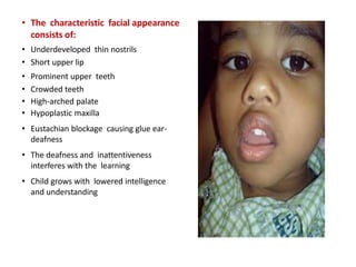 Adenoid Enlargement in children.pptx