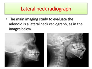 Adenoid Enlargement in children.pptx