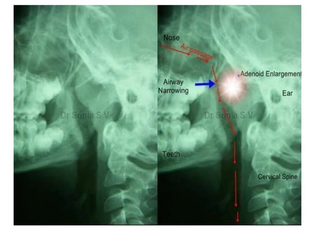 Adenoid Enlargement in children.pptx