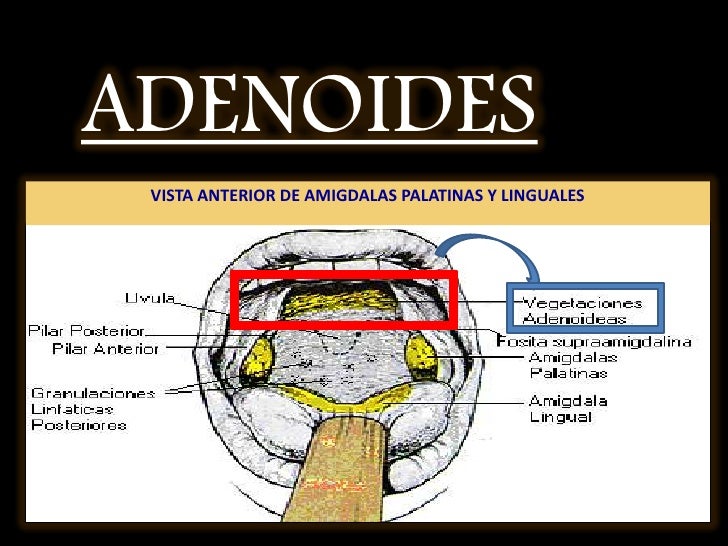 Adenoides