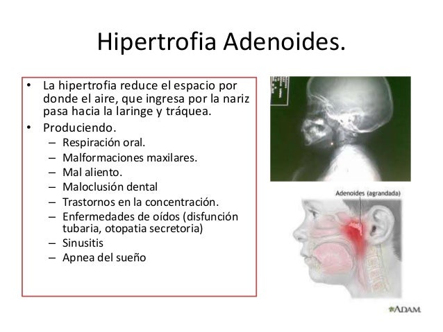Adenoides Por David Olmedo