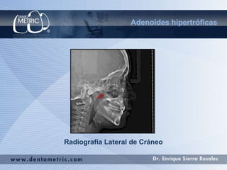Radiografía De Adenoides