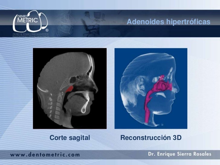 Adenoides hipertróficas