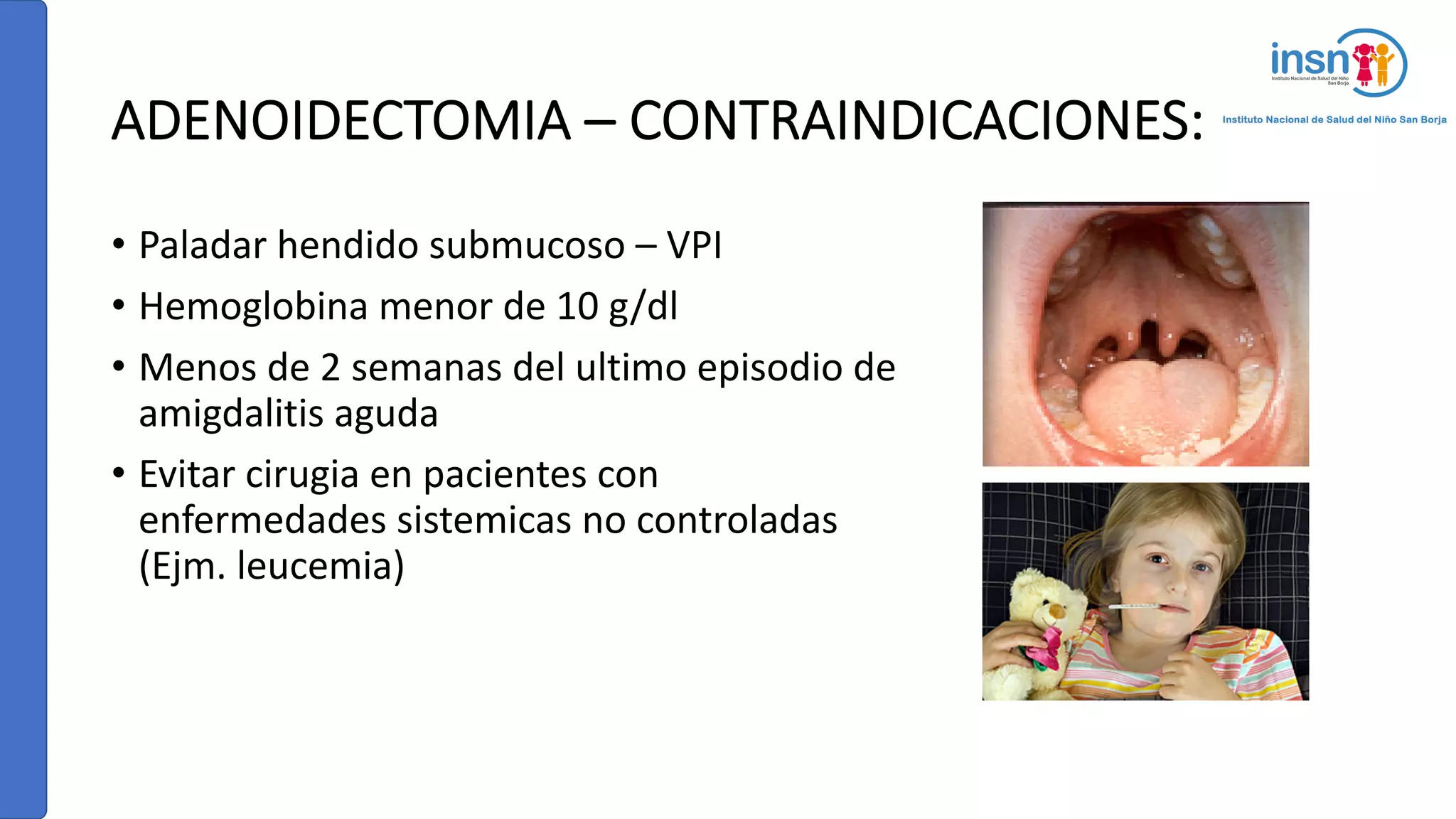 Hipertrofia de Adenoides y amigdalas - INSNSB | PDF | Ear, Nose and ...