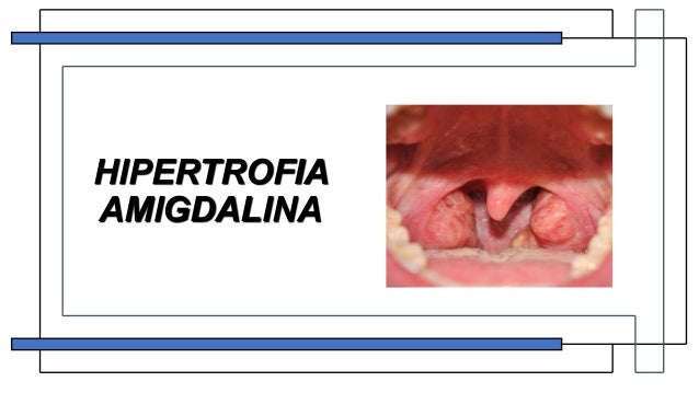 Hipertrofia de Adenoides y amigdalas - INSNSB