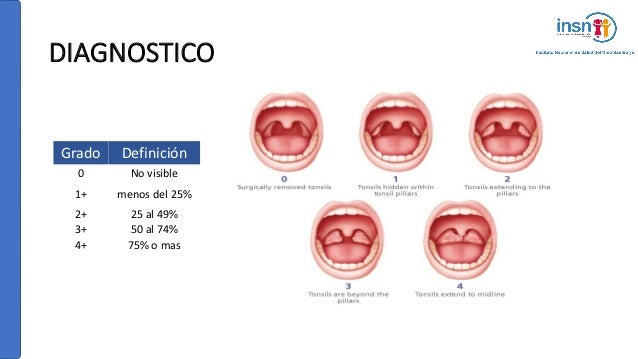 Hipertrofia de Adenoides y amigdalas - INSNSB