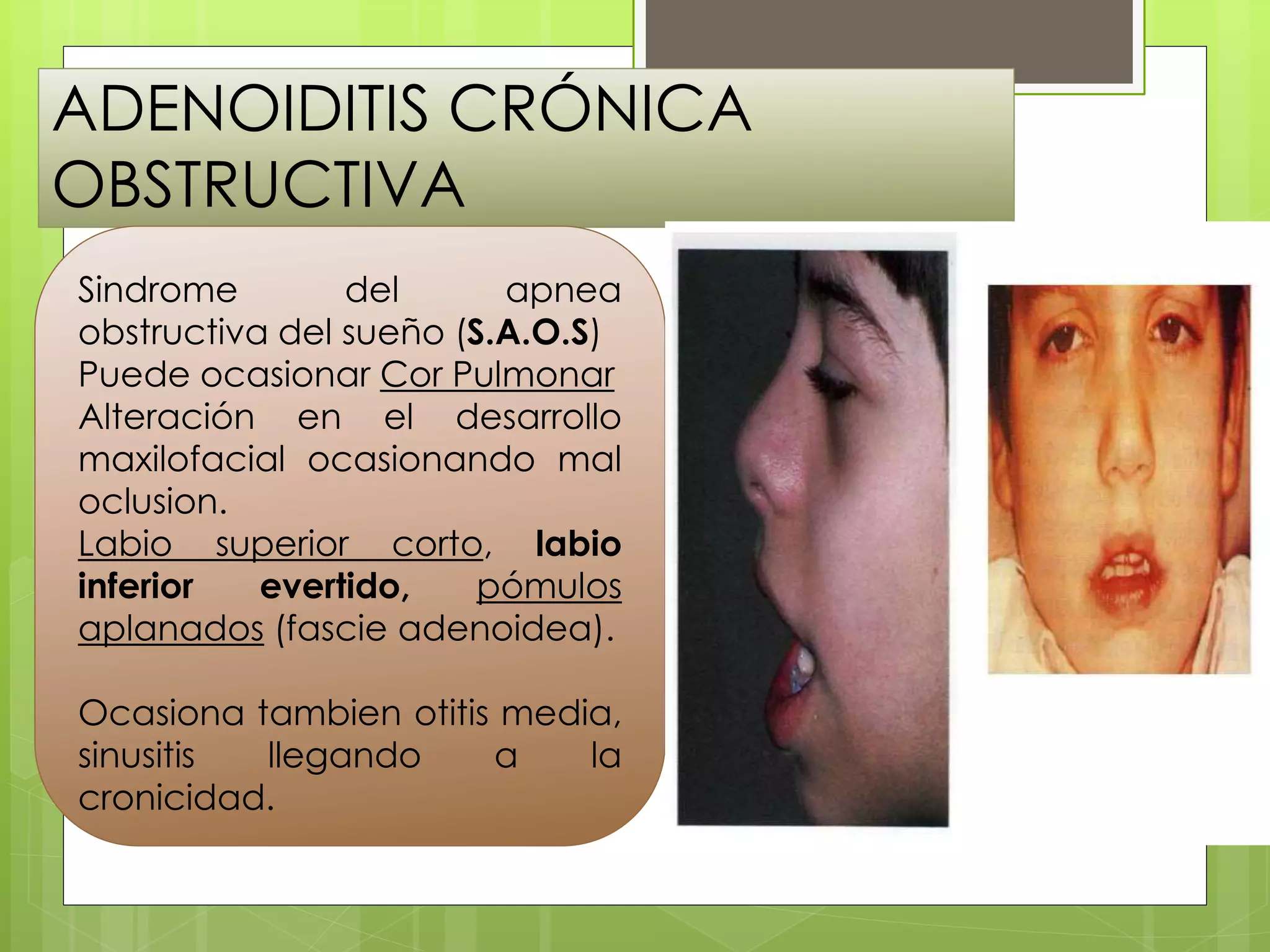 Adenoiditis | PPTX