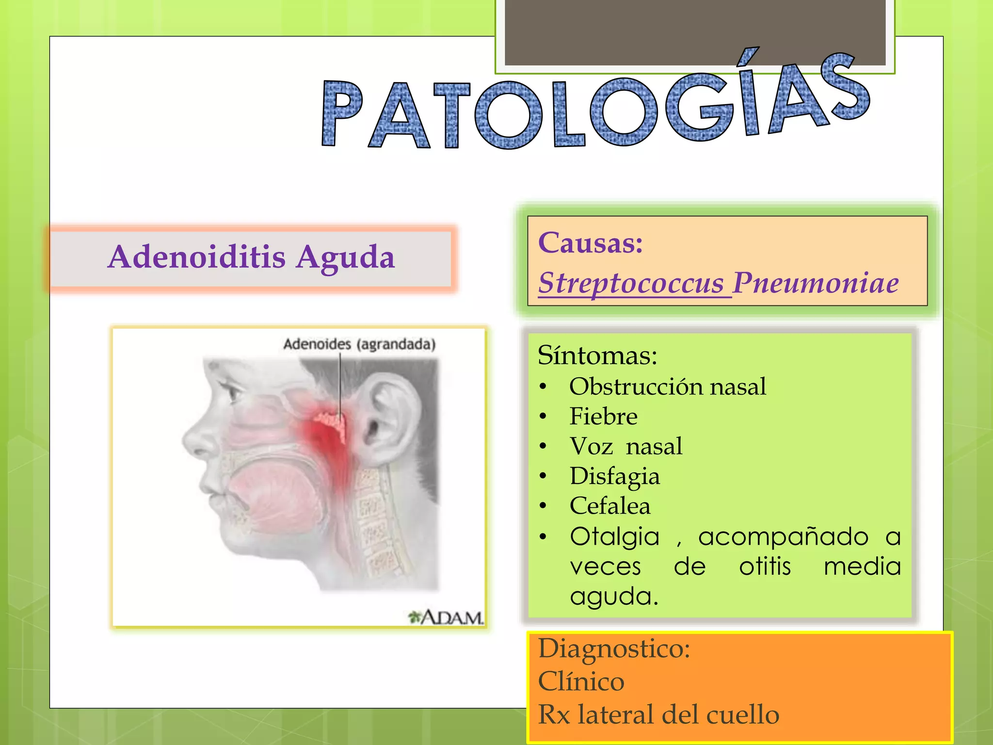 Adenoiditis | PPTX
