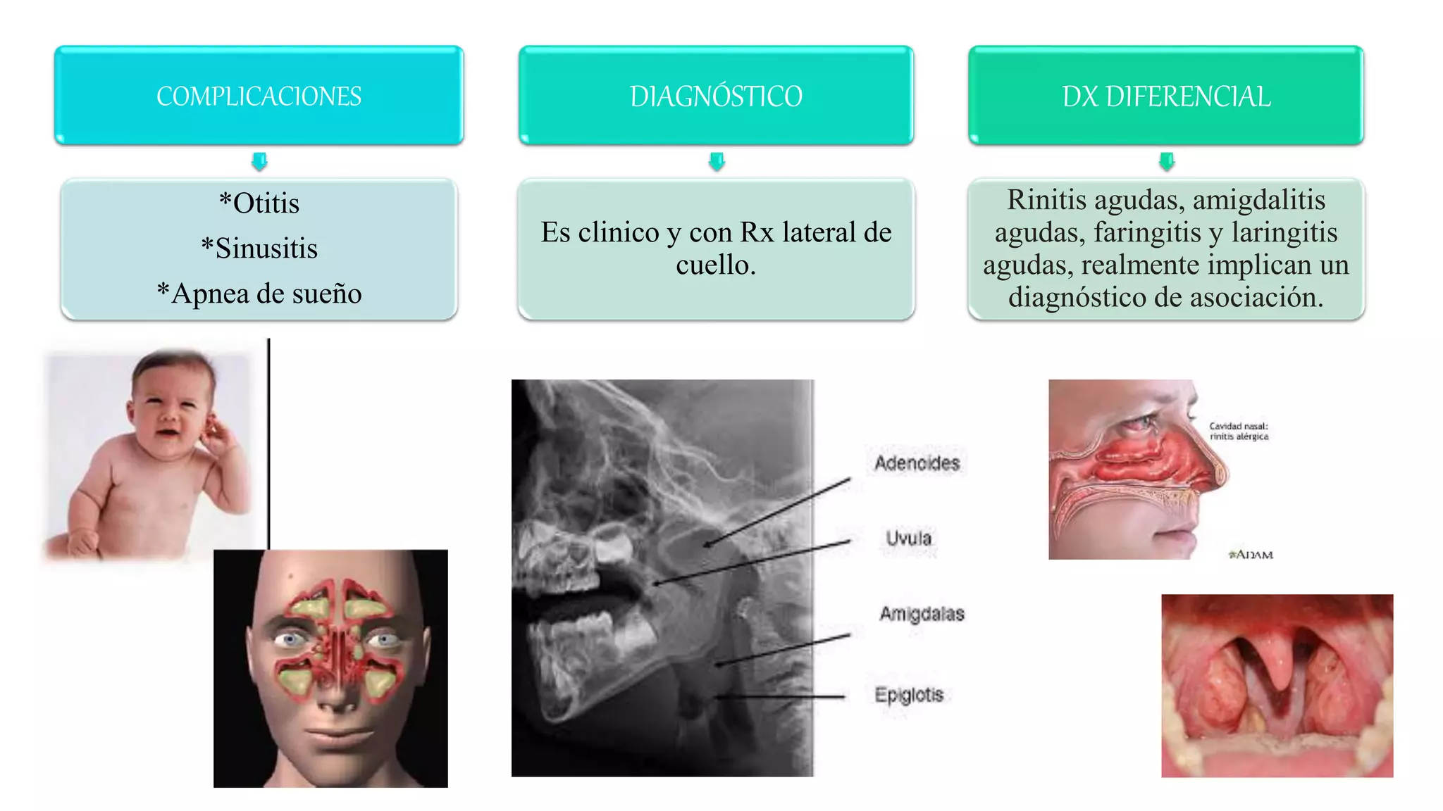 Adenoiditis, Amigdalitis, Adenoidectomía y Amigdalectomía | PPTX