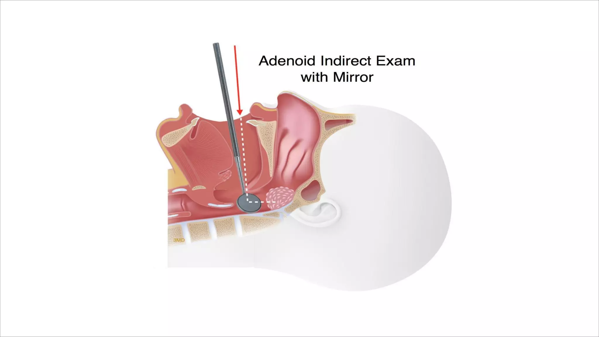 Adenoiditis - easy explanation for nursing students | PDF