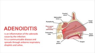 Adenoiditis - easy explanation for nursing students | PDF