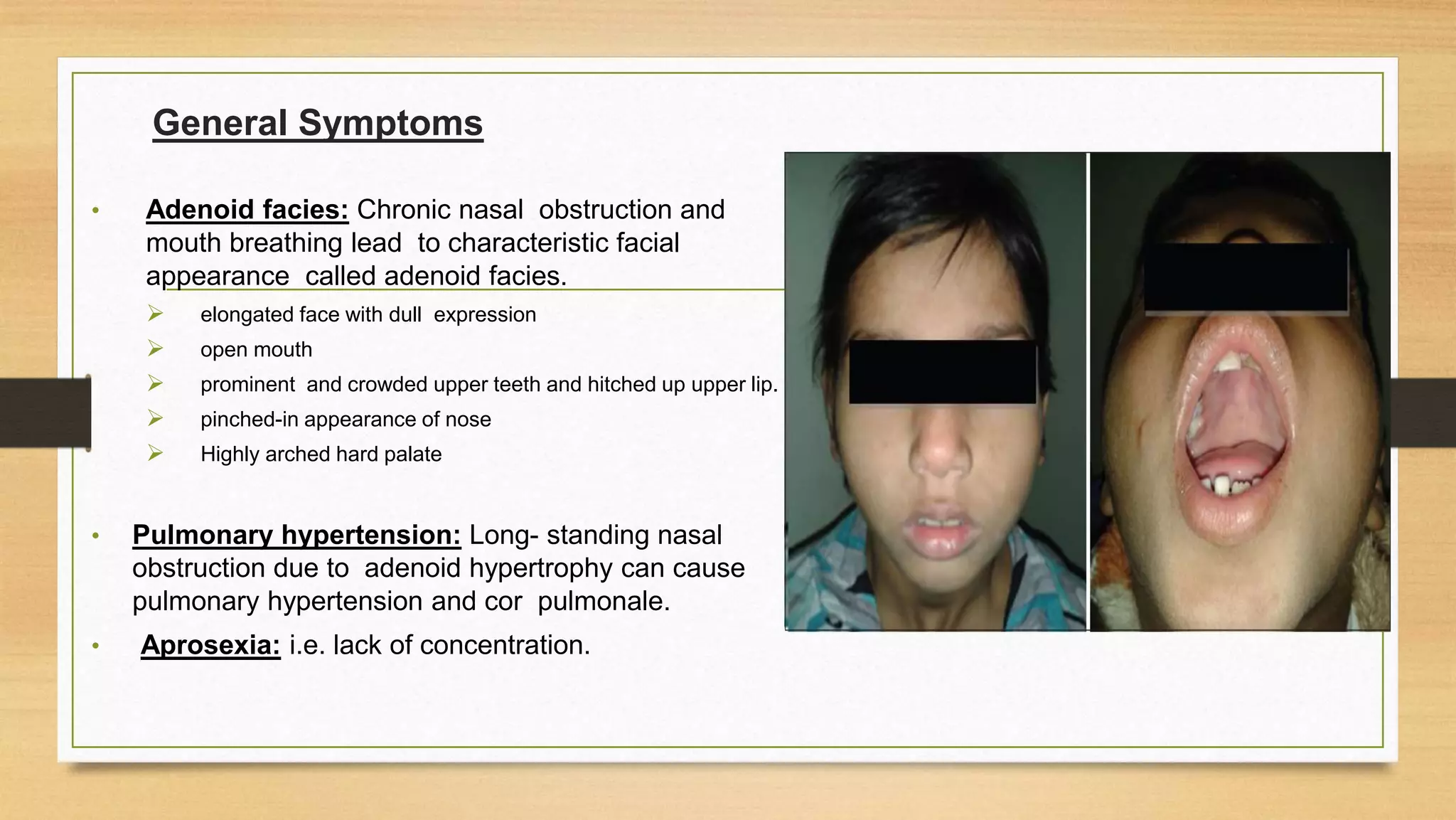 Adenoiditis & Adenoidectomy | PPTX