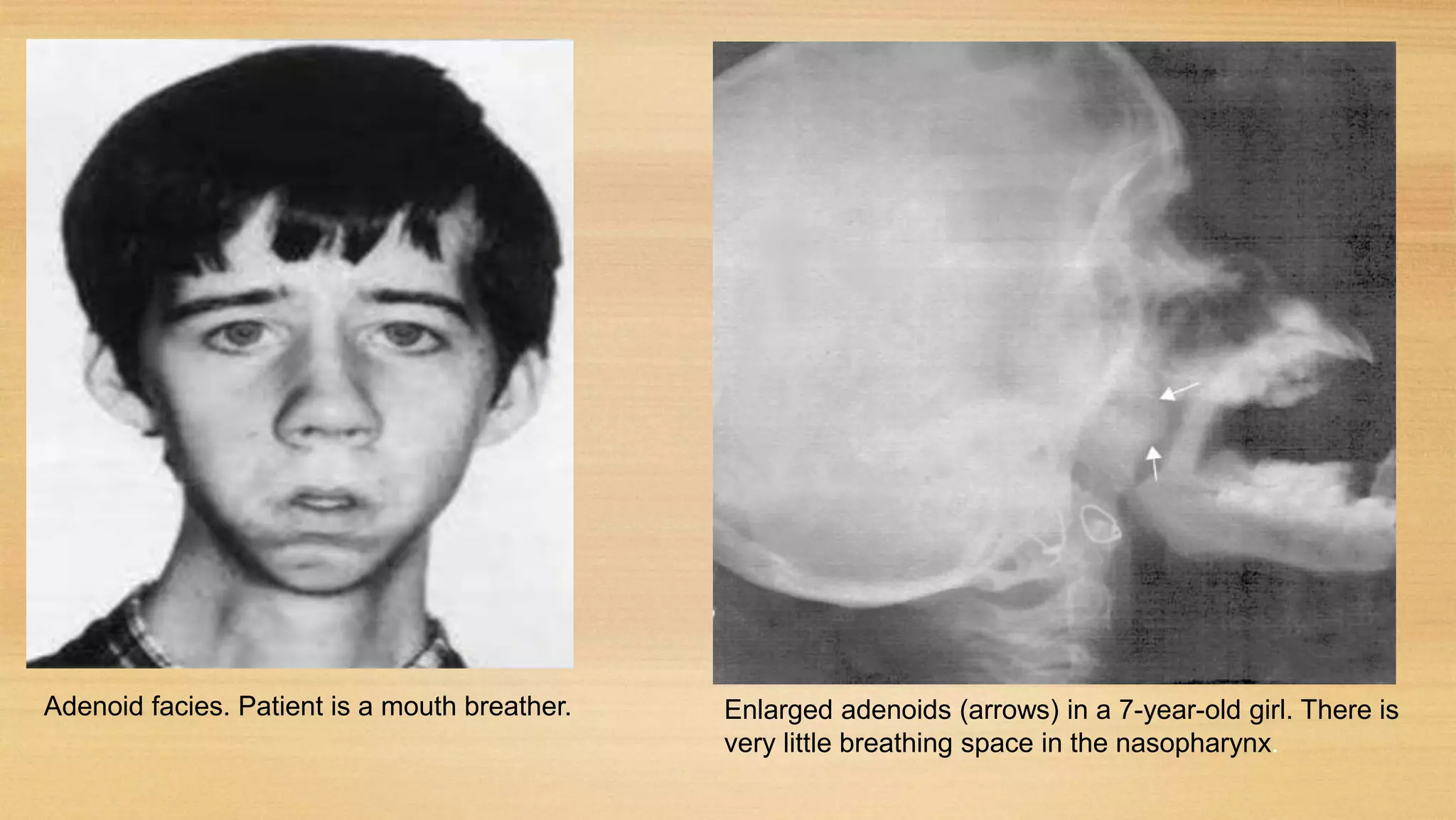 Adenoiditis & Adenoidectomy | PPTX