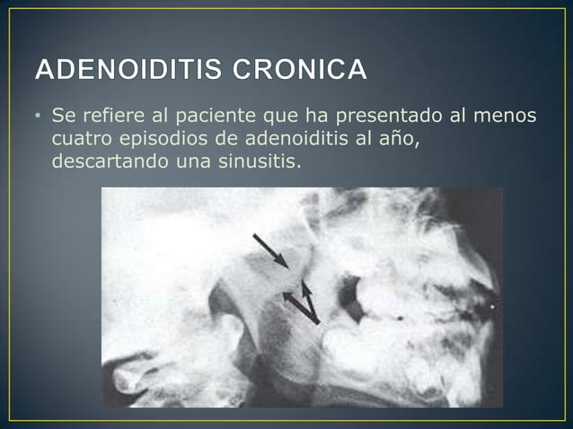 Adenoiditis aguda | PPTX