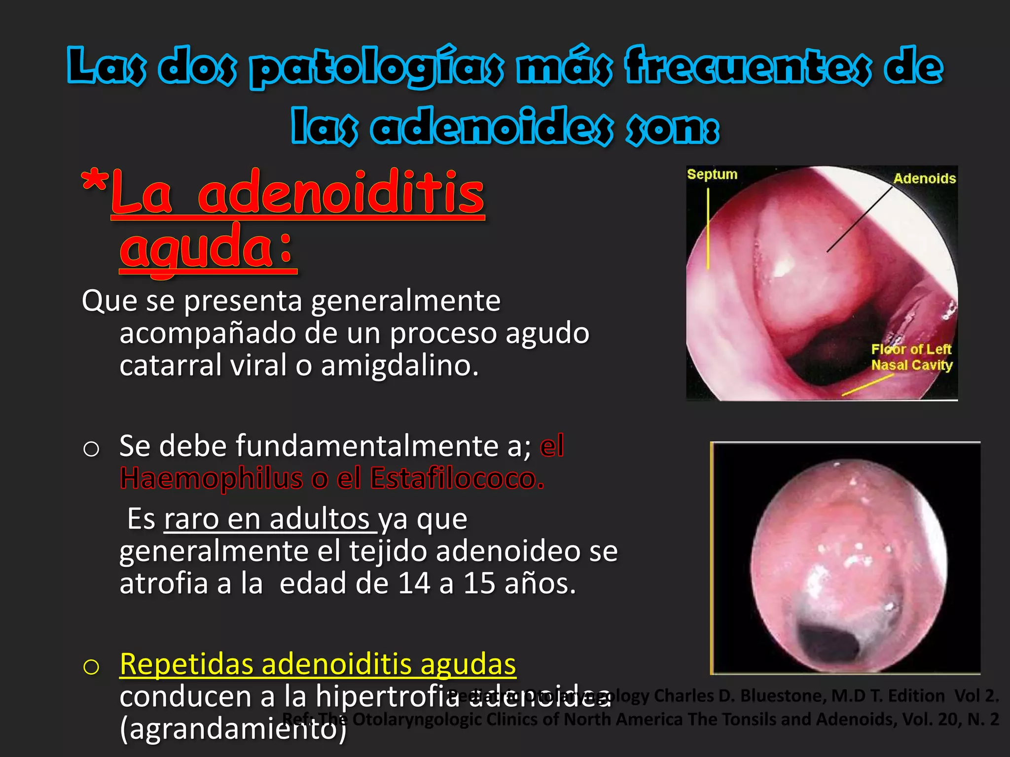 Adenoiditis e ha | PPT
