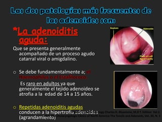 Adenoiditis e Hipertrofia de Adenoides | PPTX