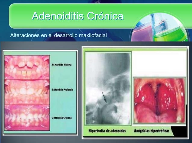 Adenoiditis y rinitis | PPT