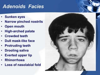 Adenoid Face Dentition