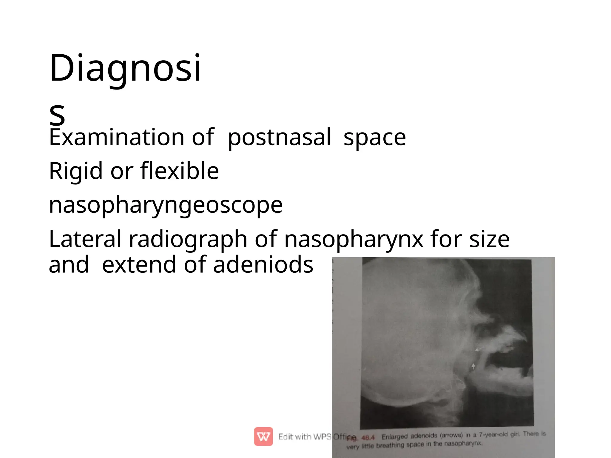 ADENOIDS-WPS Office(1).pptx ent ppt adenoids | PPTX