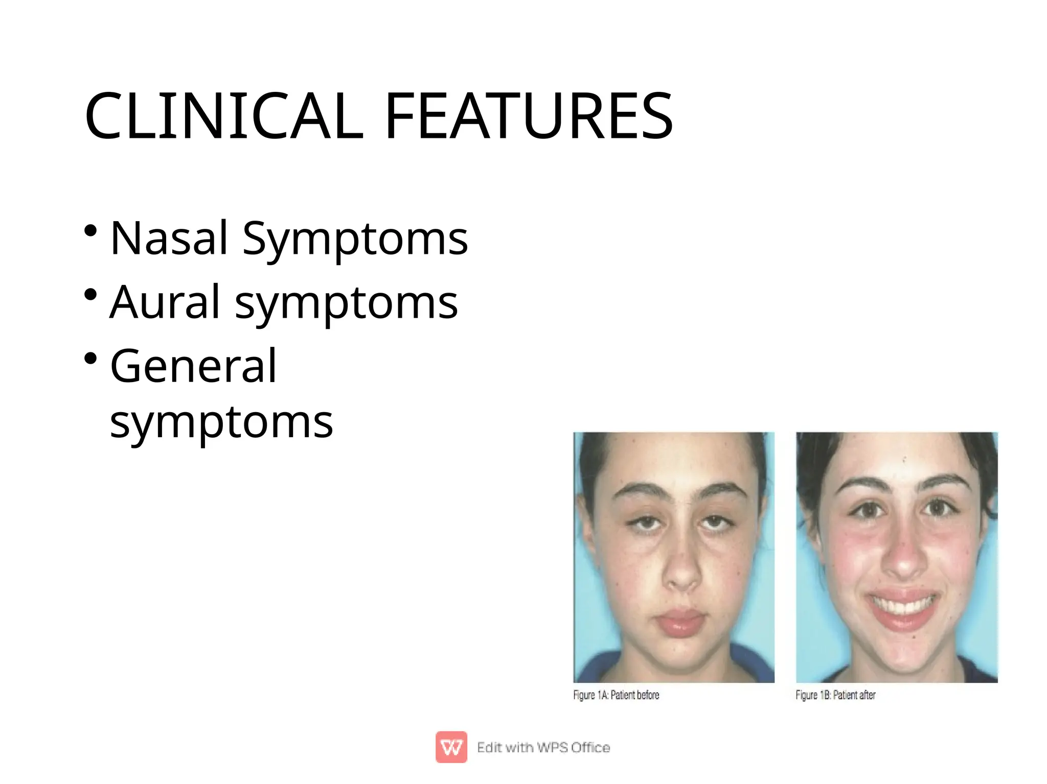 ADENOIDS-WPS Office(1).pptx ent ppt adenoids | PPTX