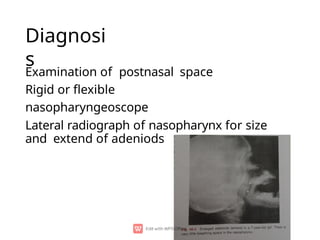ADENOIDS-WPS Office(1).pptx ent ppt adenoids | PPTX