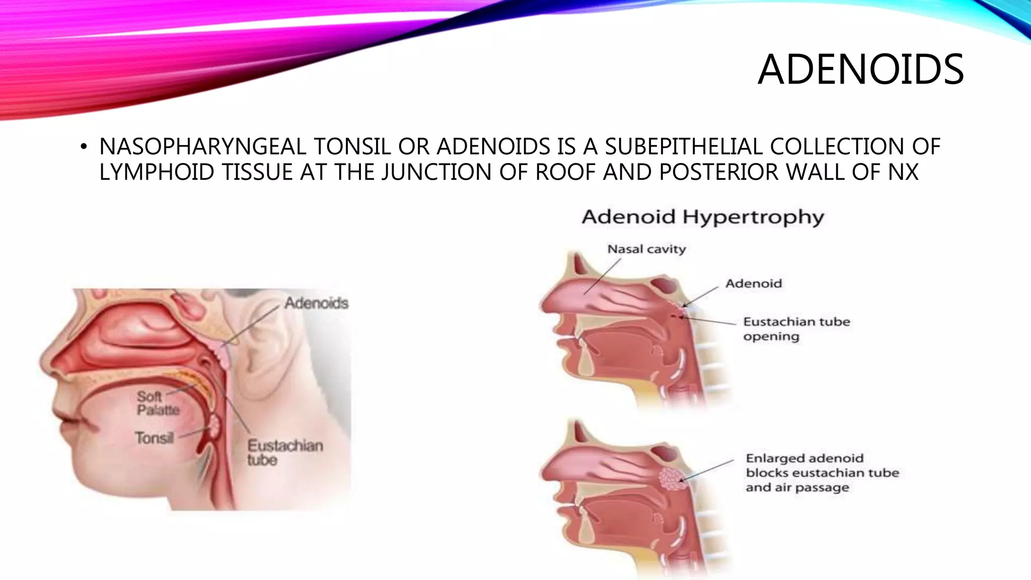 Adenoids,acute and chronic tonsillitis | PPTX