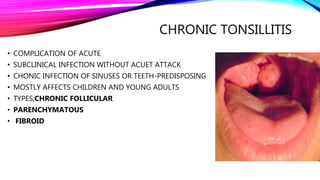 Adenoids,acute and chronic tonsillitis | PPTX