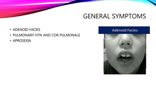Adenoids,acute and chronic tonsillitis | PPTX