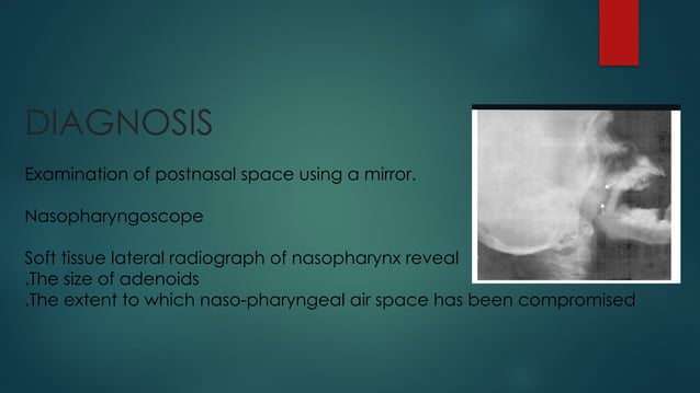 Adenoids Ppt Presentation Pptx Education Ppt