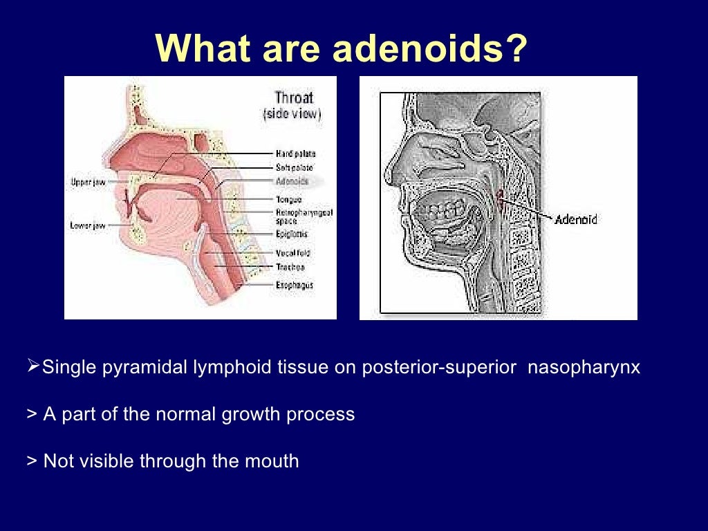 Adenoids Hypertrophy