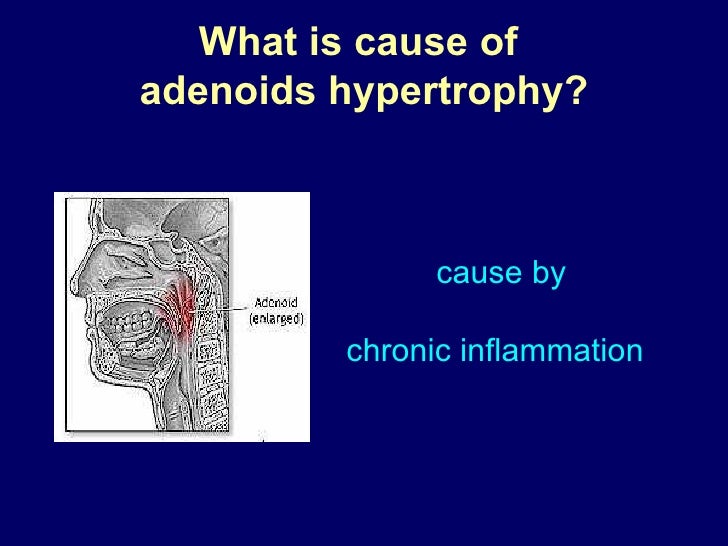 Adenoid Hypertophy What Is It Causes Symptoms Diagnosis Treatment