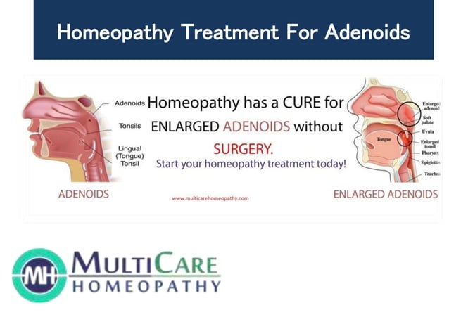 Homeopathic Medicines for ADENOIDS treatment | PPT