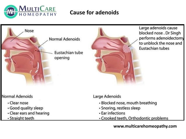 Homeopathic Medicines for ADENOIDS treatment | PPT