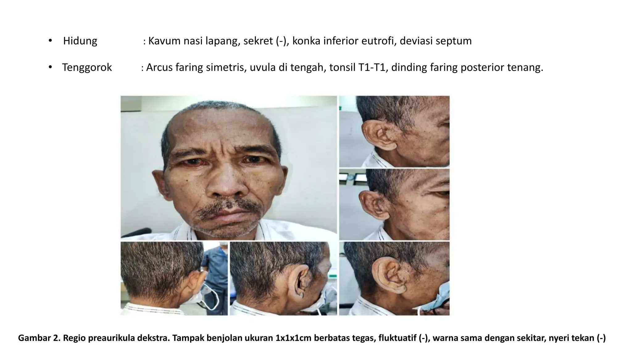 ADENOKARSINOMA SERUMINOSA (1).pptx pada telinga | PPTX